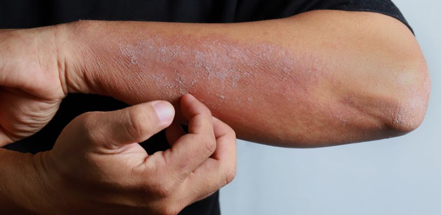 Eczema and Psoriasis | What are the Differences Between Them?